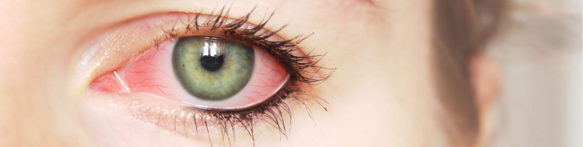 Conjunctivitis - The Vision Clinic
